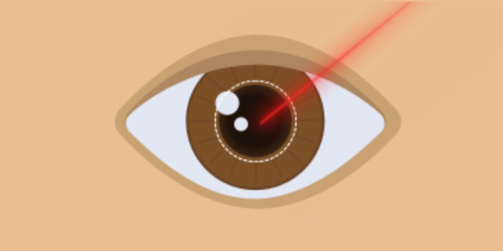 SmartSurf-TransPRK | The Lasik Surgery Clinic PH