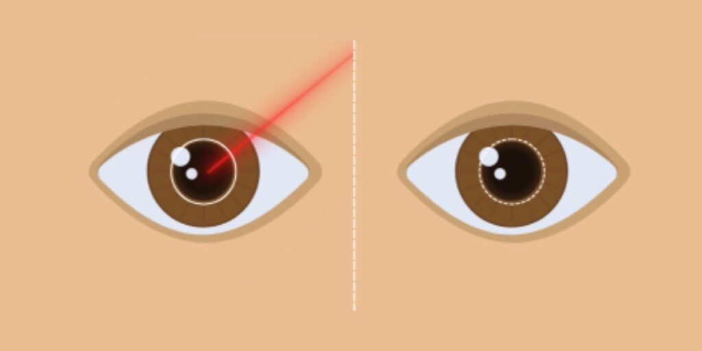 SmartSurf-TransPRK | The Lasik Surgery Clinic PH