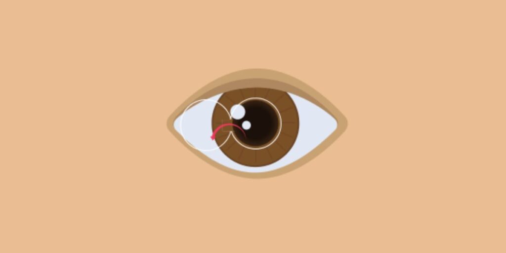 Conventional Lasik | The Lasik Surgery Clinic PH