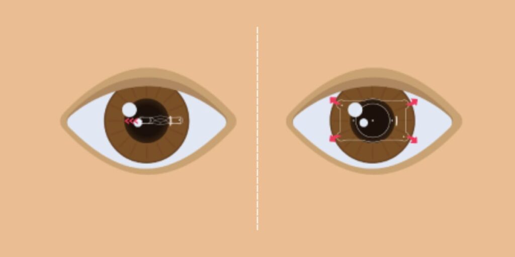 Implantable Contact Lens | The Lasik Surgery Clinic PH
