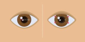Implantable Contact Lens | The Lasik Surgery Clinic PH